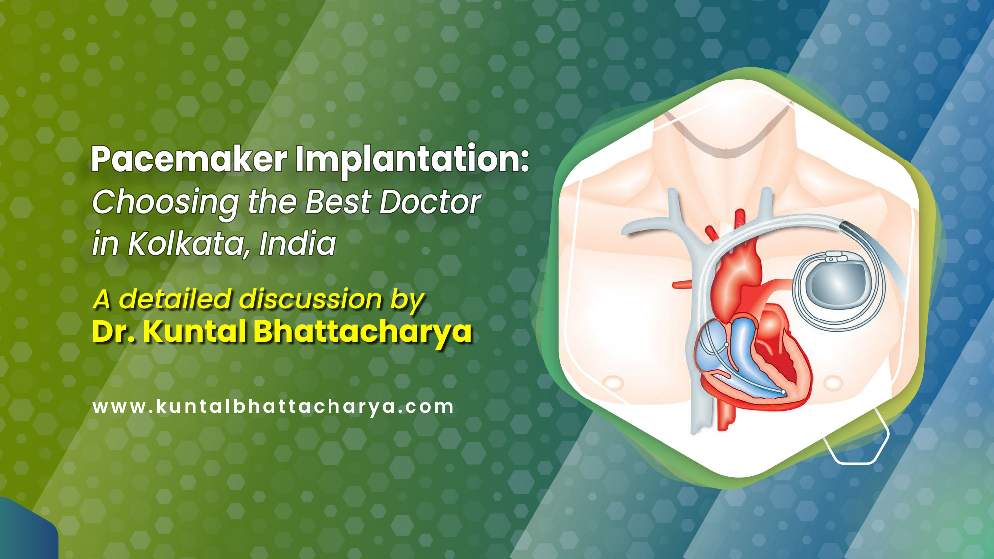 Pacemaker Implantation: Choosing the Best Doctor in Kolkata