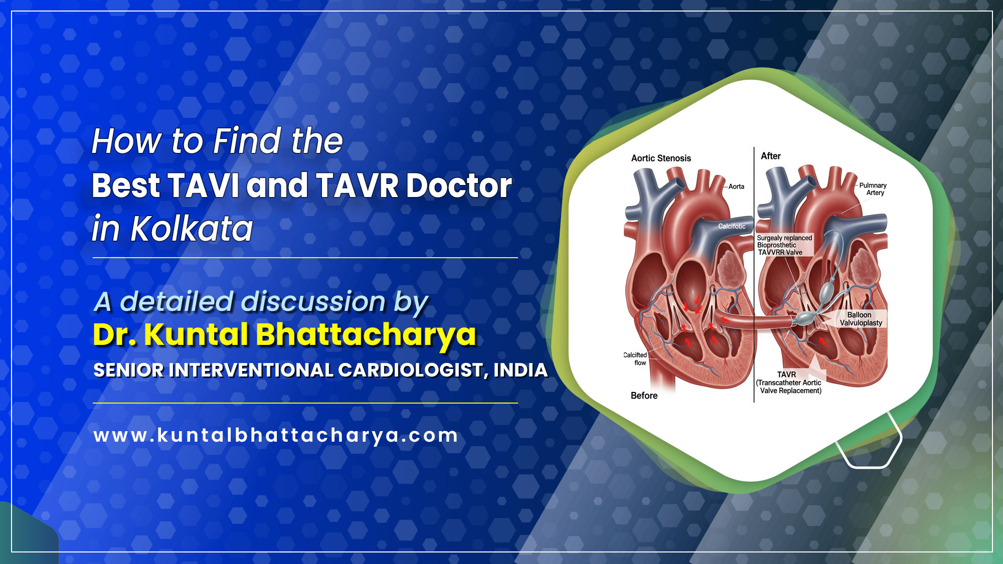 How to Find the Best TAVI and TAVR Doctor in Kolkata in 2025