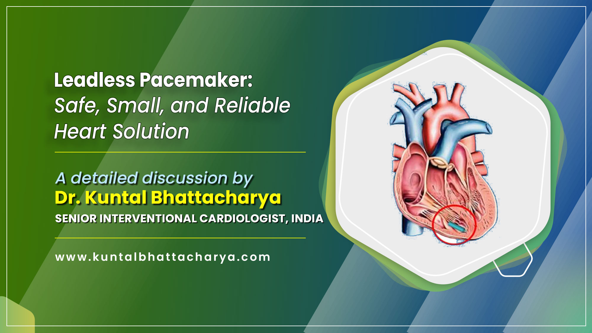 Leadless Pacemaker: Safe, Small, and Reliable Heart Solution by Dr ...
