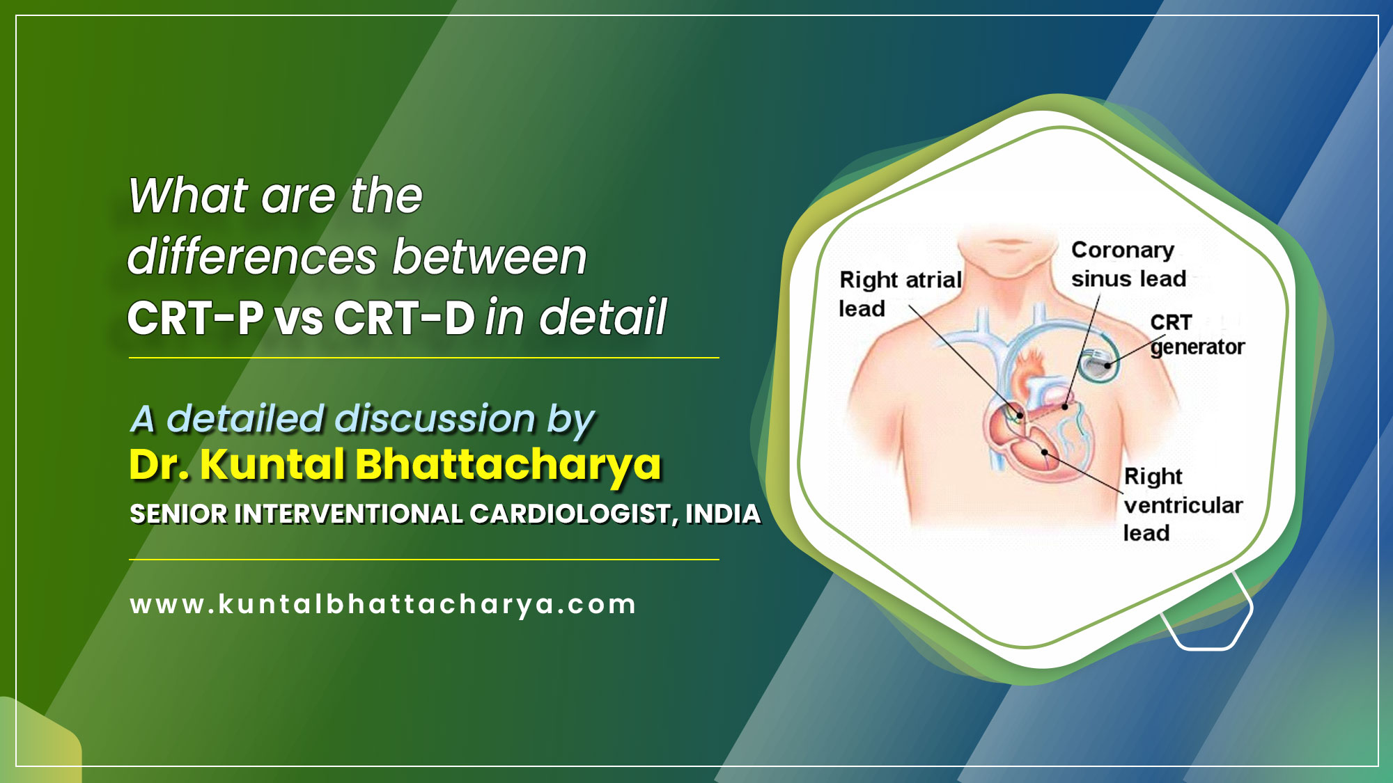 CRT-P vs CRT-D: A Detailed Guide to Understanding the Difference